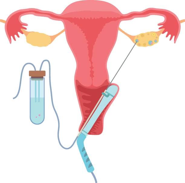 Shaving Before Egg Retrieval: Essential Tips for Optimal Results Shaving Before Egg Retrieval: Essential Tips for Optimal Results